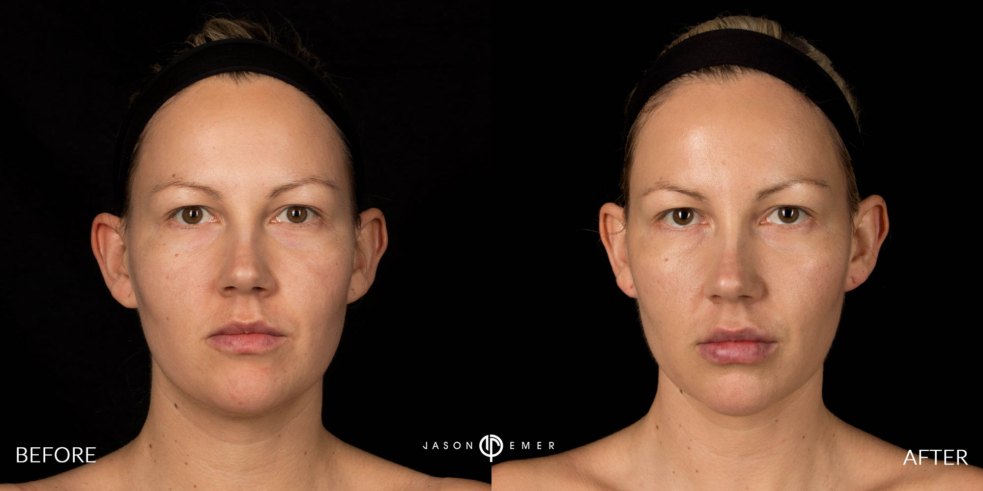 Facial Sculpting - Female - Cosmetic Dermatologist Dr. Jason Emer